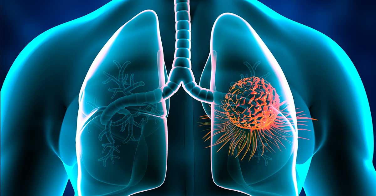 Lung Cancer - Health365